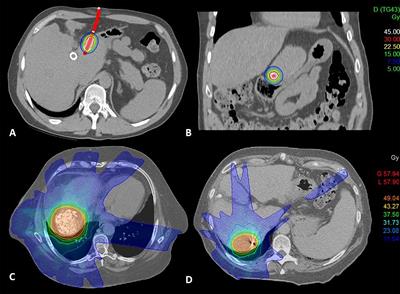 Frontiers | HDR Brachytherapy and SBRT as Bridging Therapy to Liver Transplantation in HCC ...